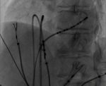 Radiofrequency Catheter Ablation | Ruth Kam Heart & Arrhythmia Clinic