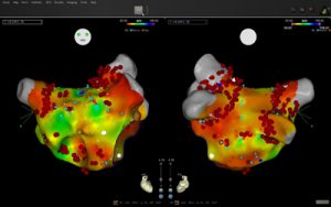 Radiofrequency Catheter Ablation | Ruth Kam Heart & Arrhythmia Clinic