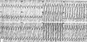 Ventricular Tachycardia (VT) | Ruth Kam Heart & Arrhythmia Clinic